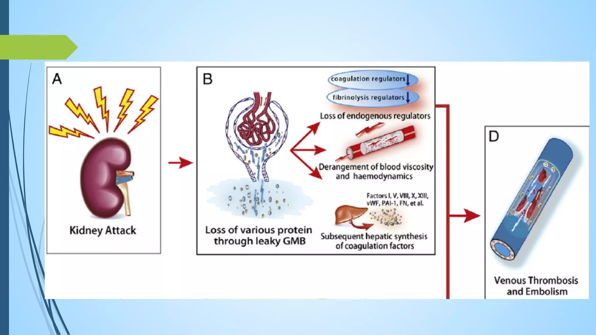 Nephrotic Syndrome .pdf