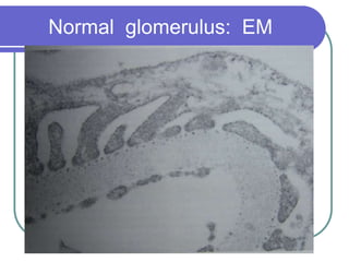 NEPHROTIC SYNDROME in children education | PPTX