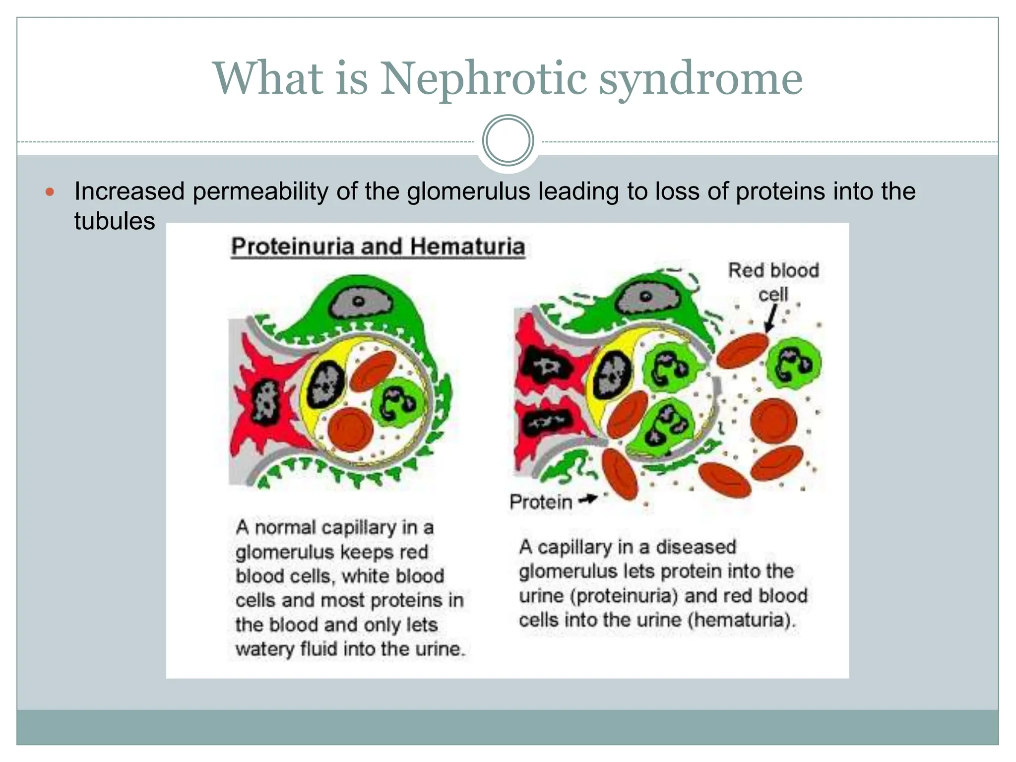 Nephrotic and nephritic Syndrome children 7.ppt