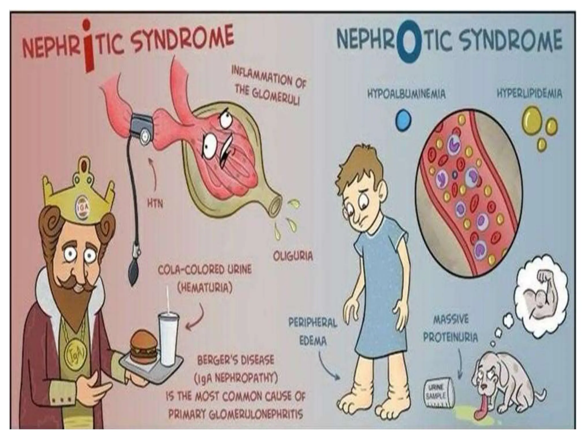 Pediatrics Nephrotic and Nephritic Syndrome 7.ppt