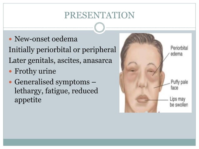 Pediatrics Nephrotic and Nephritic Syndrome 7.ppt