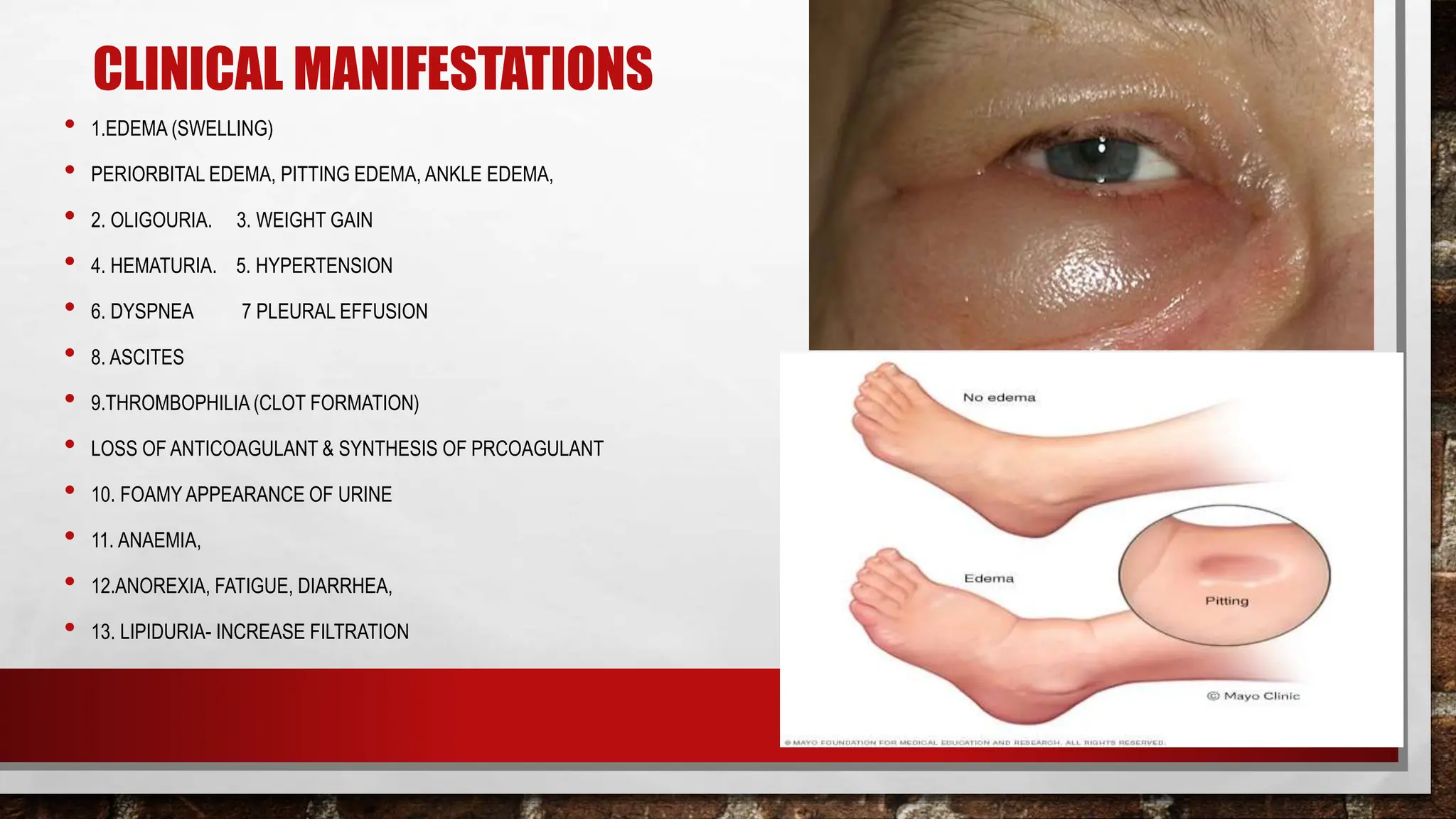 Nephrotic syndrome Renal function s..pptx
