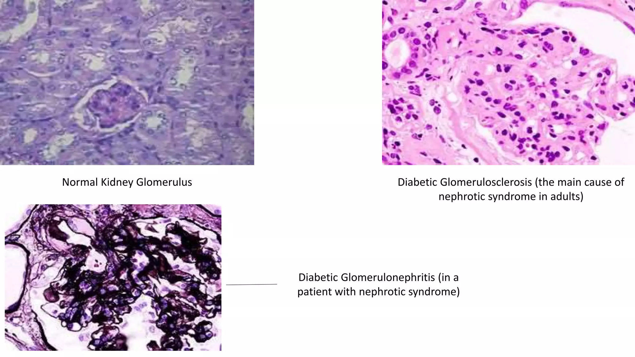 Nephrotic syndrome [full] | PPT