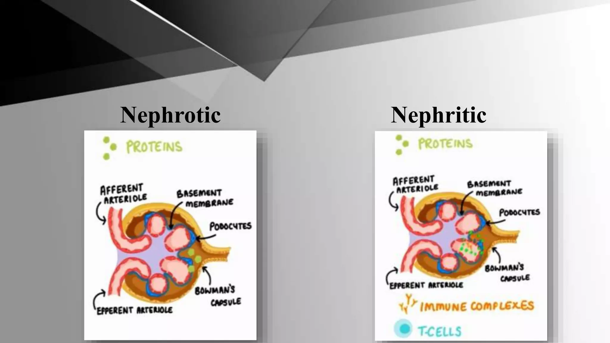 Nephrotic vs nephritic.pptx