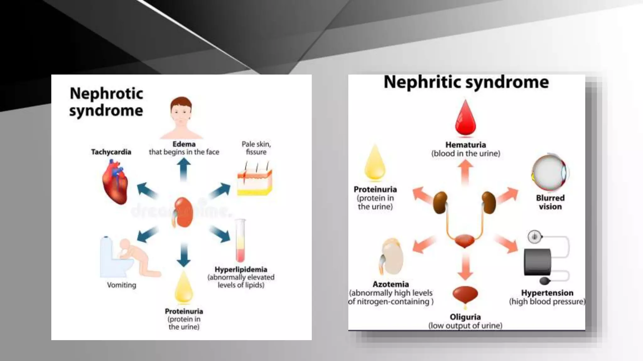 Nephrotic vs nephritic.pptx