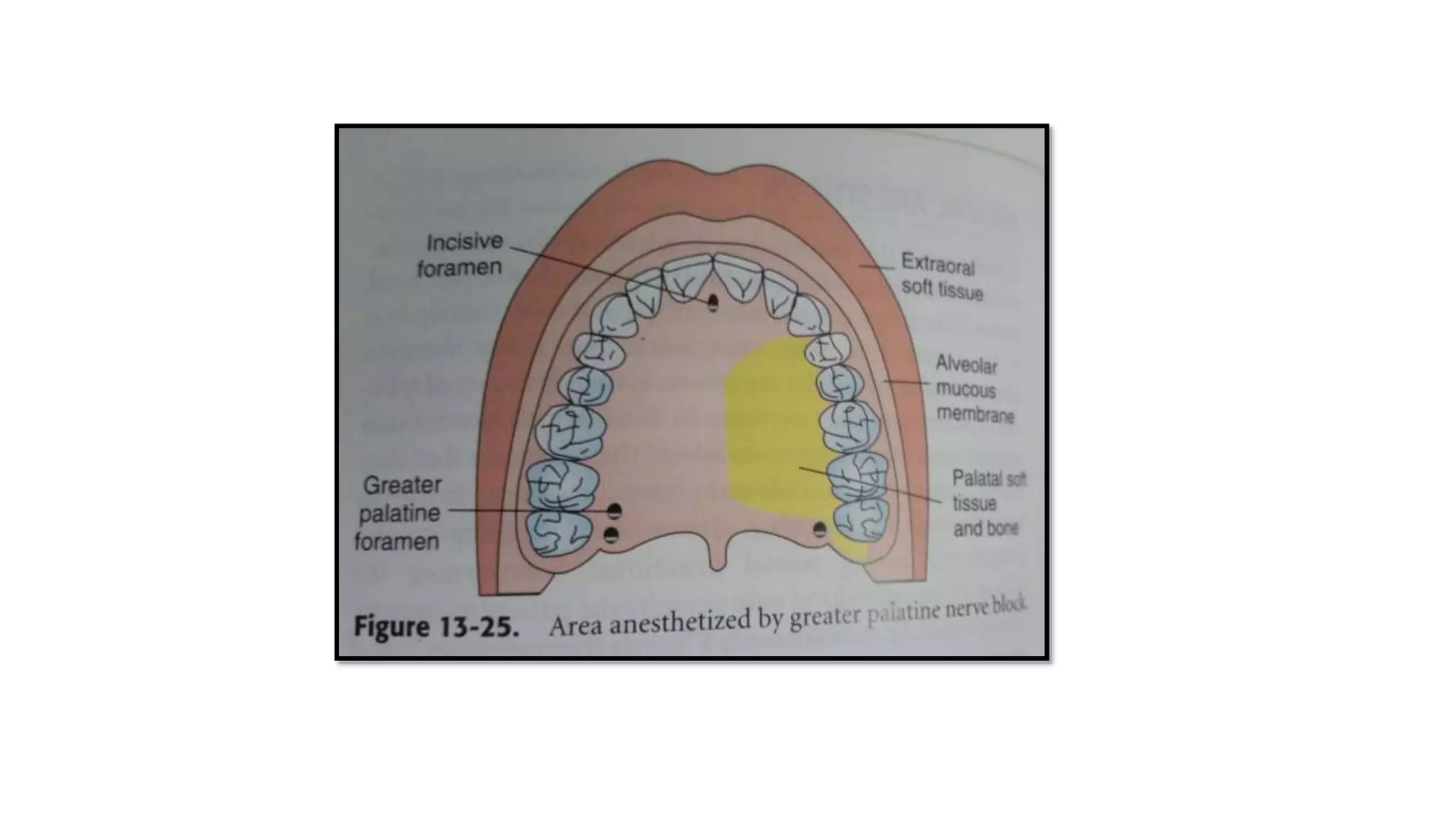Nerv block - PSA & GREATER PALATINE NERVE BLOCK | PPTX