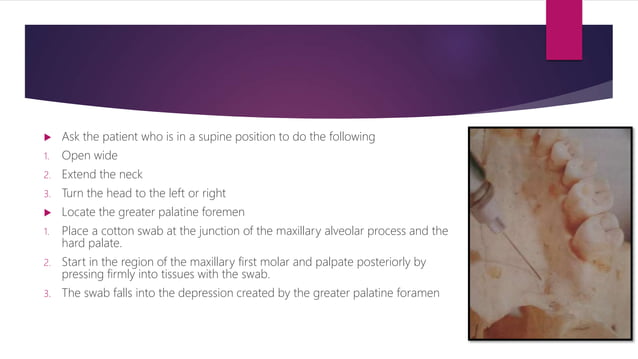 Nerv block - PSA & GREATER PALATINE NERVE BLOCK | PPTX | First Aid ...