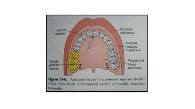 Nerv block - PSA & GREATER PALATINE NERVE BLOCK