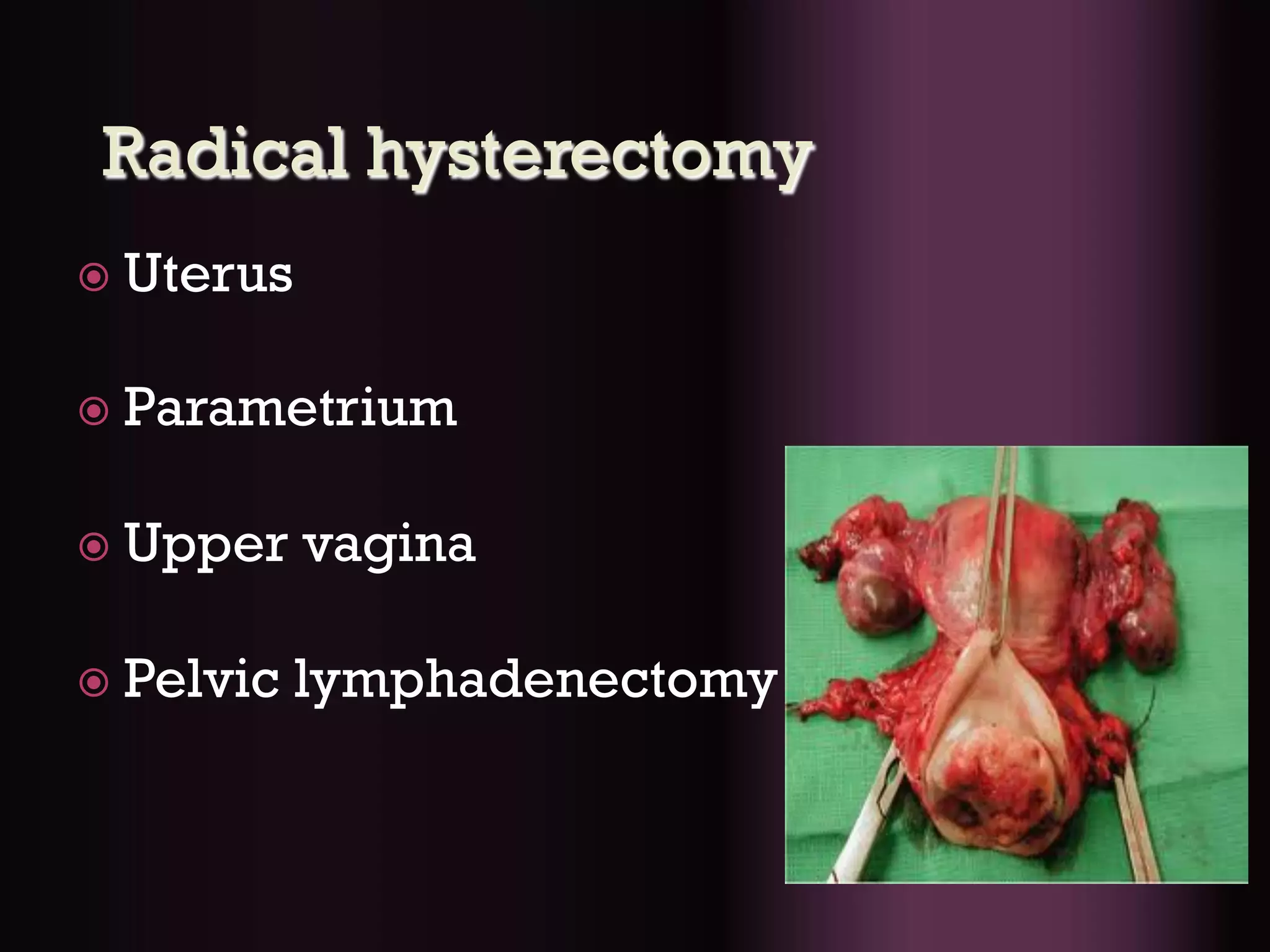 Nerve sparing radiacal hys 1 jan | PDF