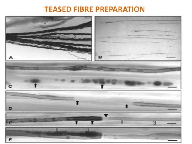 Nerve biopsy | PPTX | Brain and Nervous System Disorders | Diseases and ...