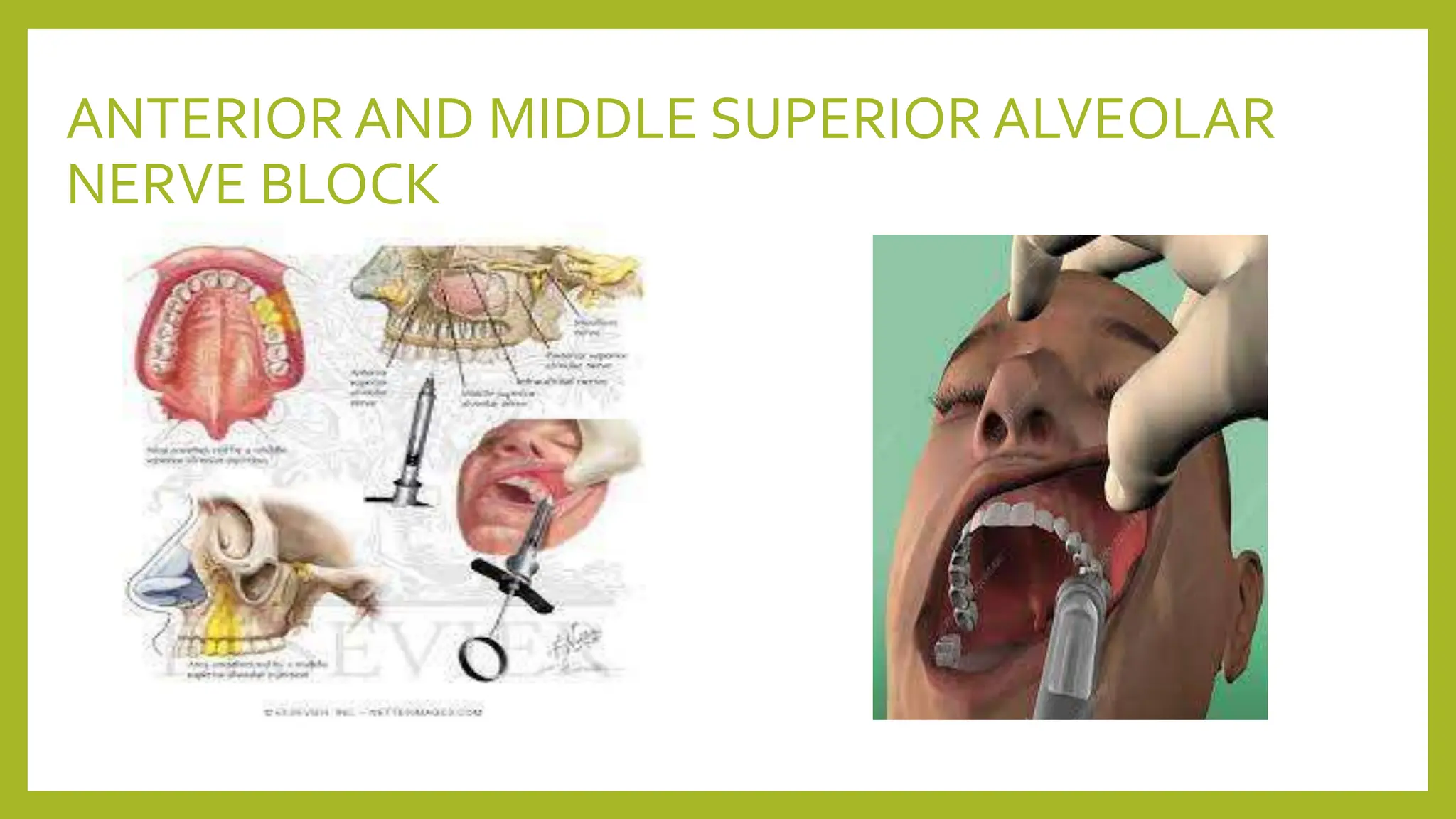 nerve blcks 2.pptx ppsa nasopalatine nerve | PPTX