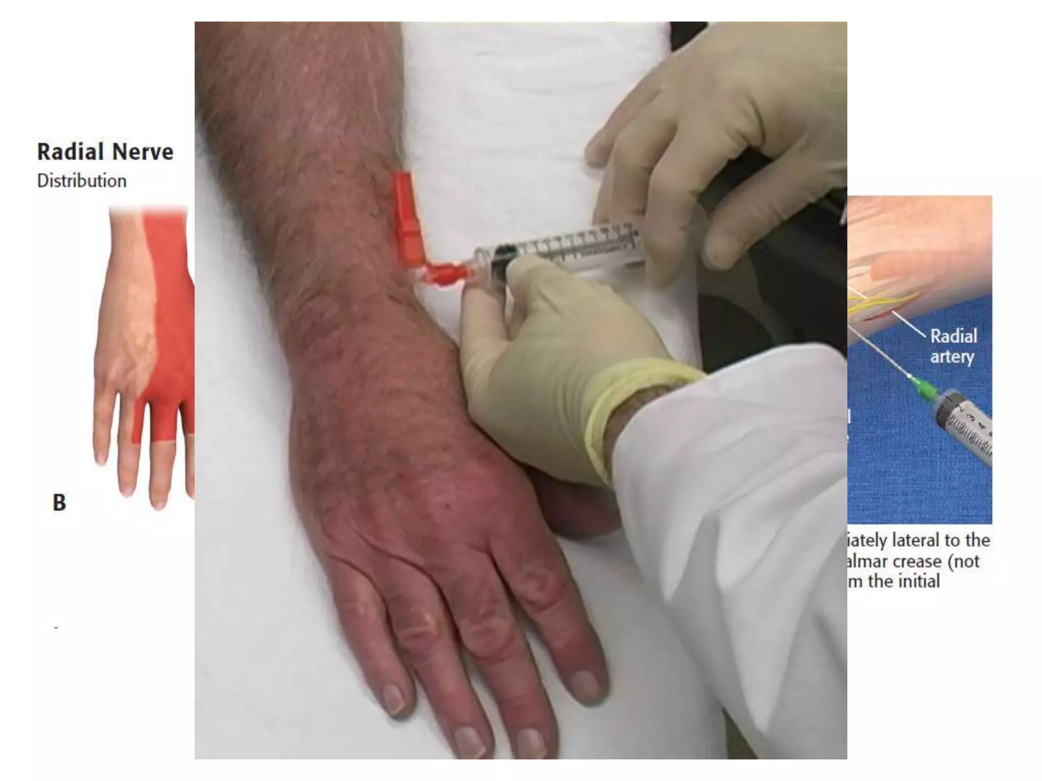 Nerve block | PPTX