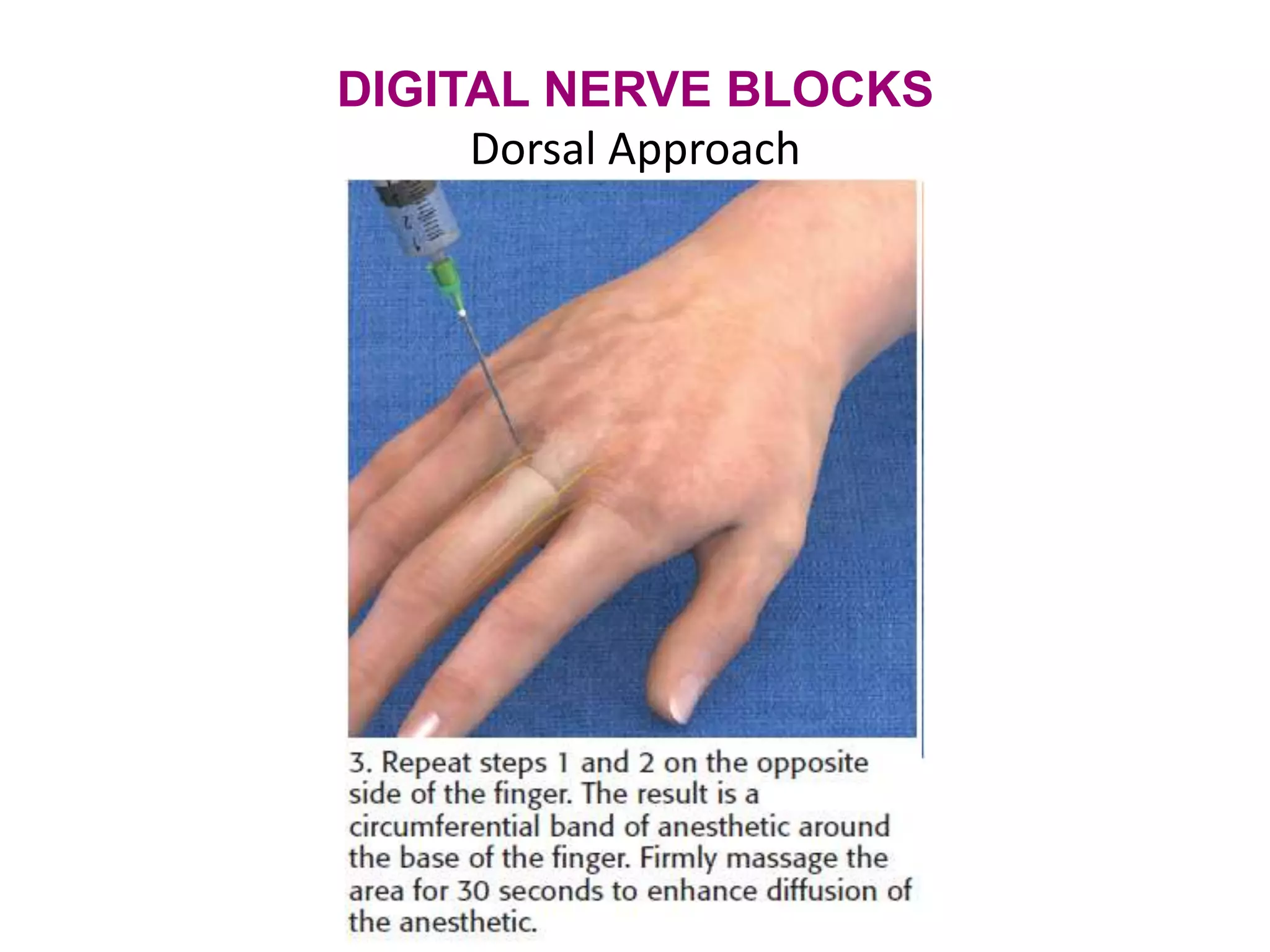 Nerve block | PPTX