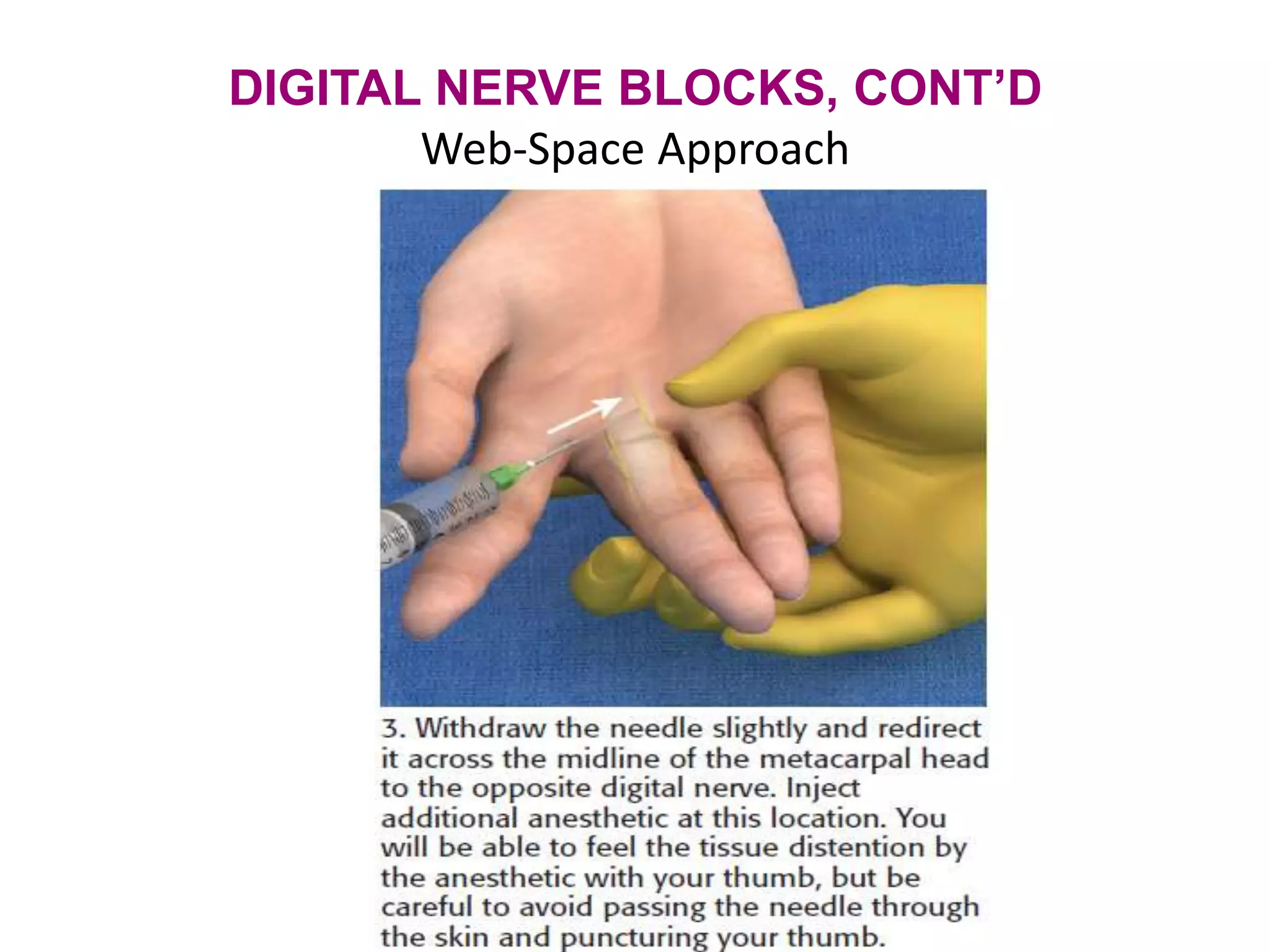 Nerve block | PPTX