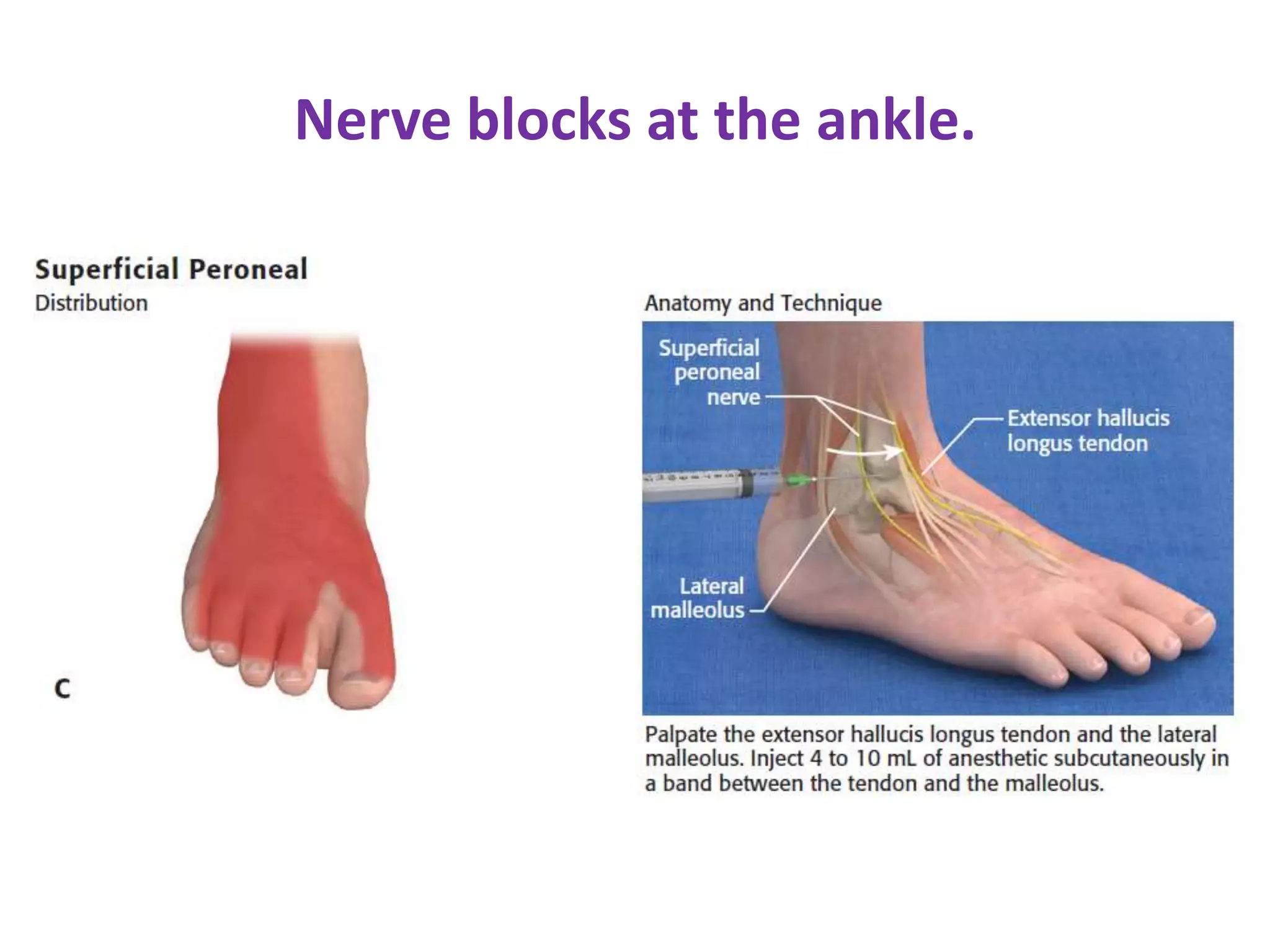 Nerve block | PPTX
