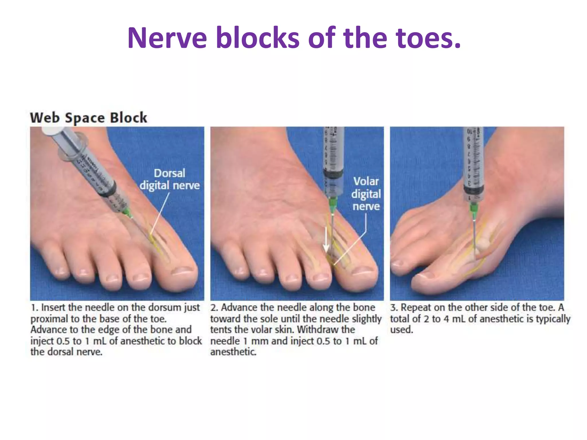 Nerve block | PPTX