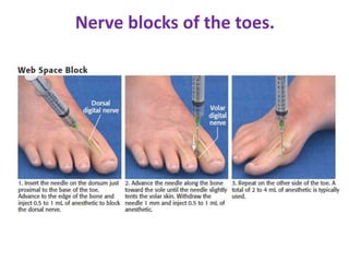 Nerve block | PPT