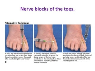 Nerve block | PPT
