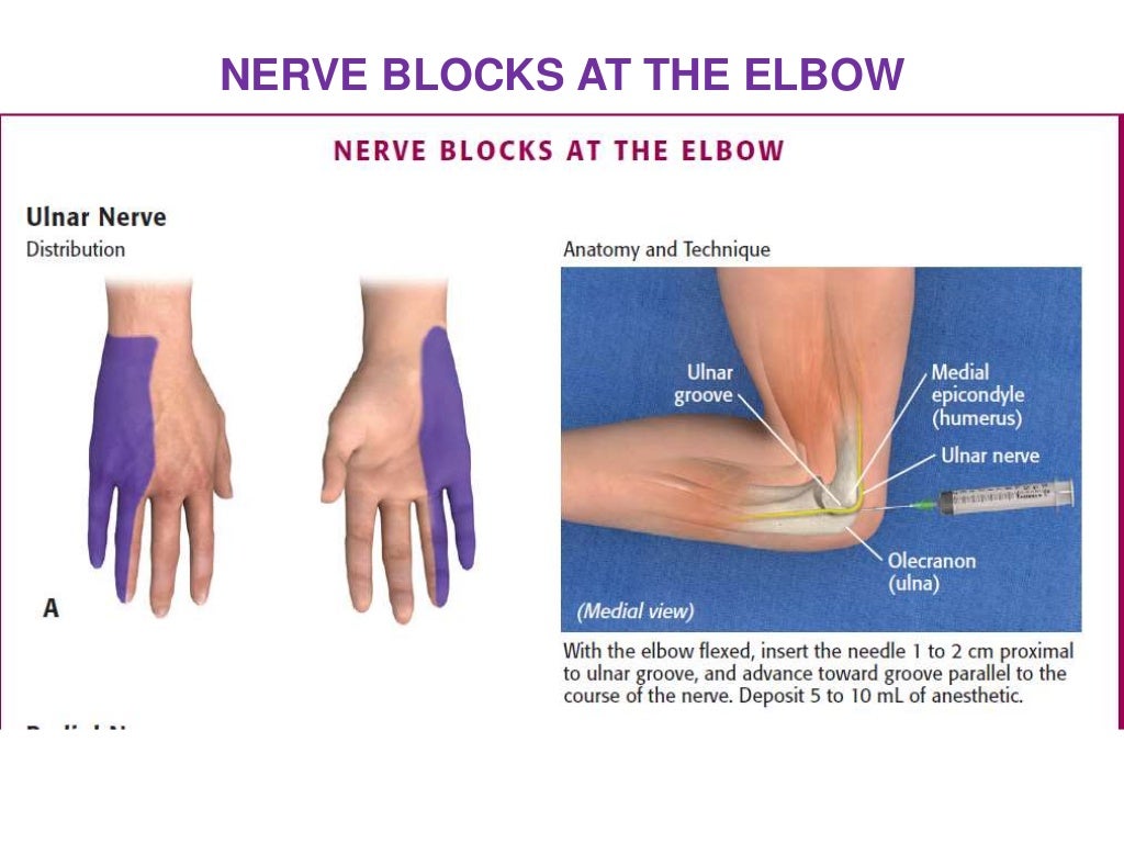 Nerve block