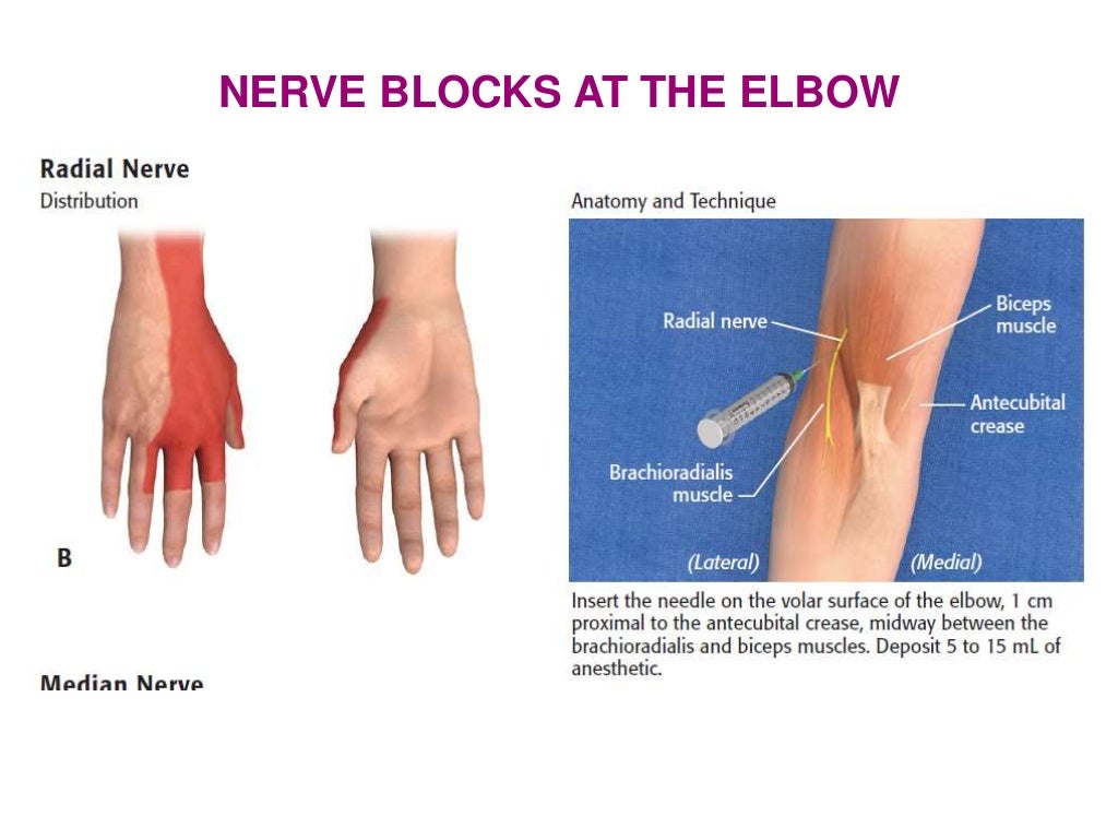 Nerve block