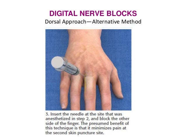 Nerve block