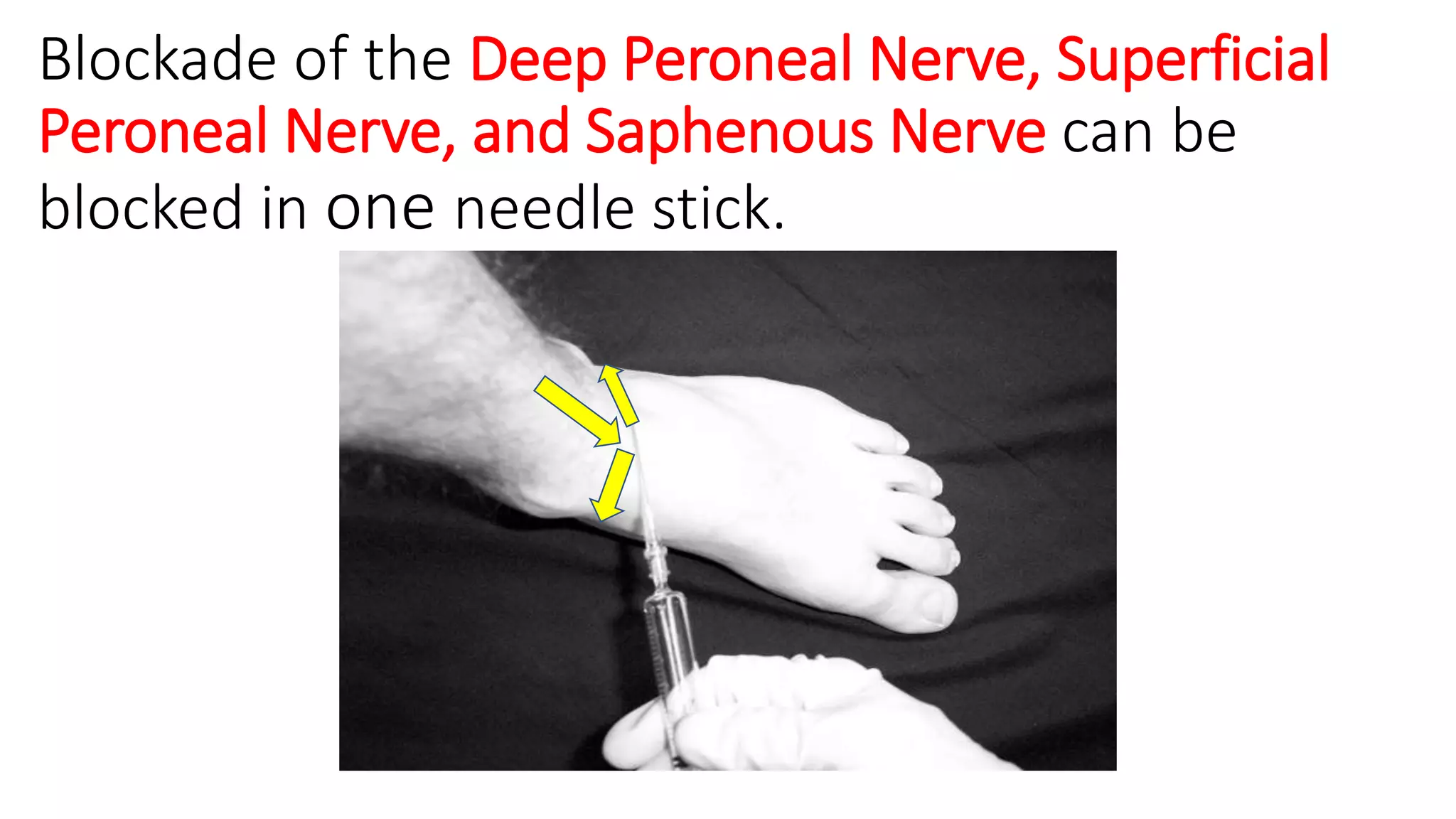 Peripheral Nerve block(ankle block,wrist block, digital block) | PPTX