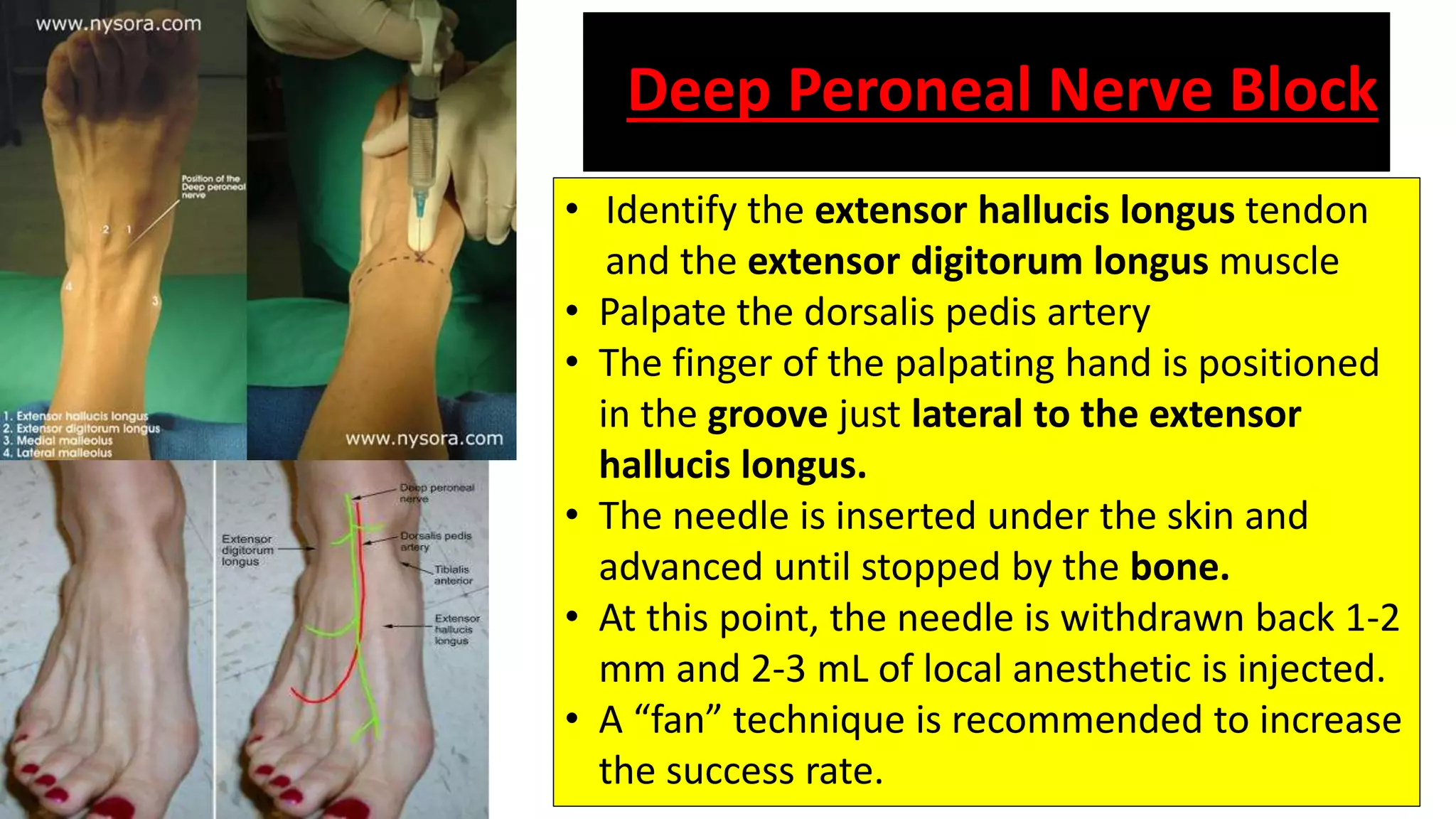 Peripheral Nerve block(ankle block,wrist block, digital block) | PPTX