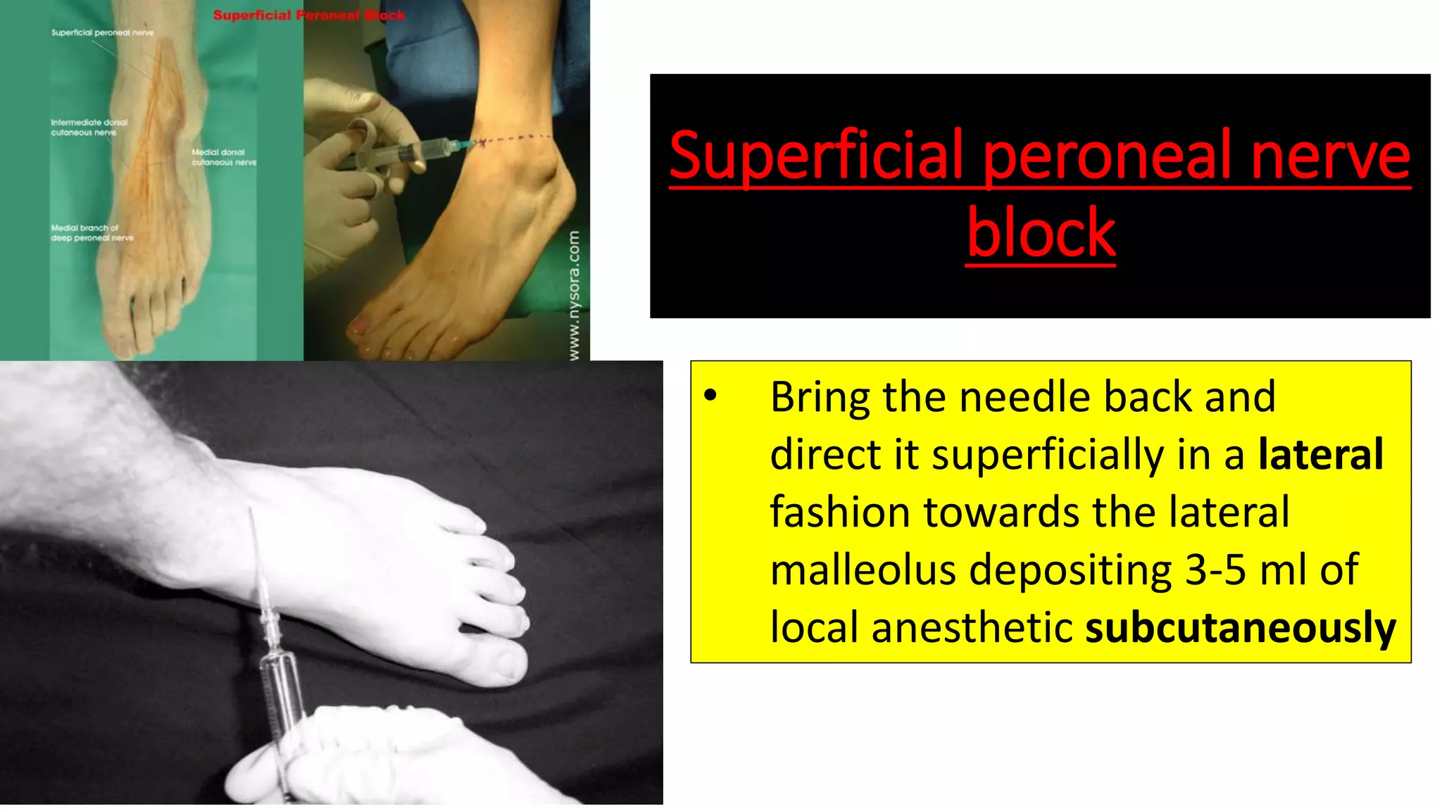 Peripheral Nerve block(ankle block,wrist block, digital block) | PPTX