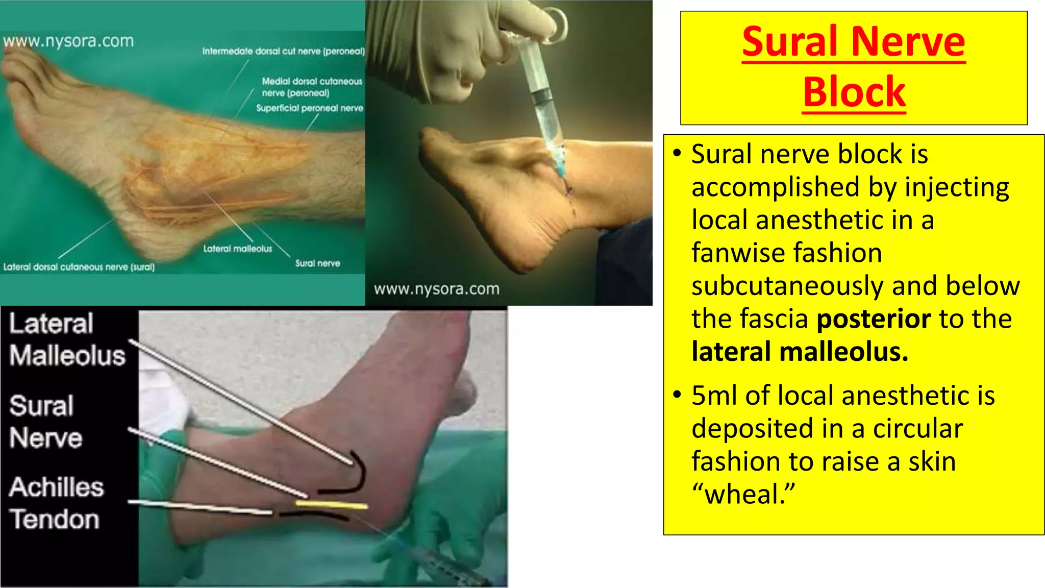 Peripheral Nerve block(ankle block,wrist block, digital block) | PPTX