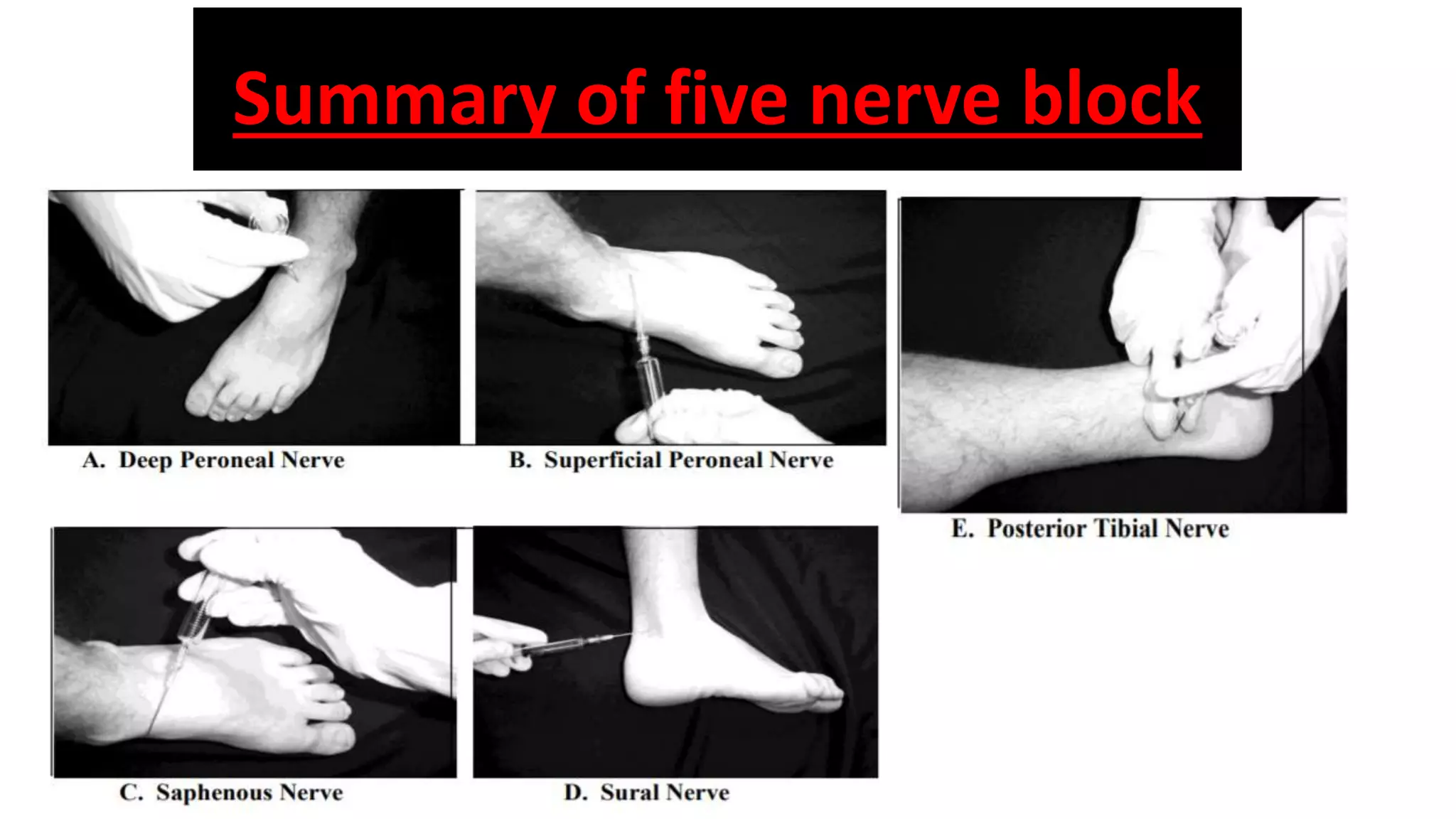 Peripheral Nerve block(ankle block,wrist block, digital block) | PPTX