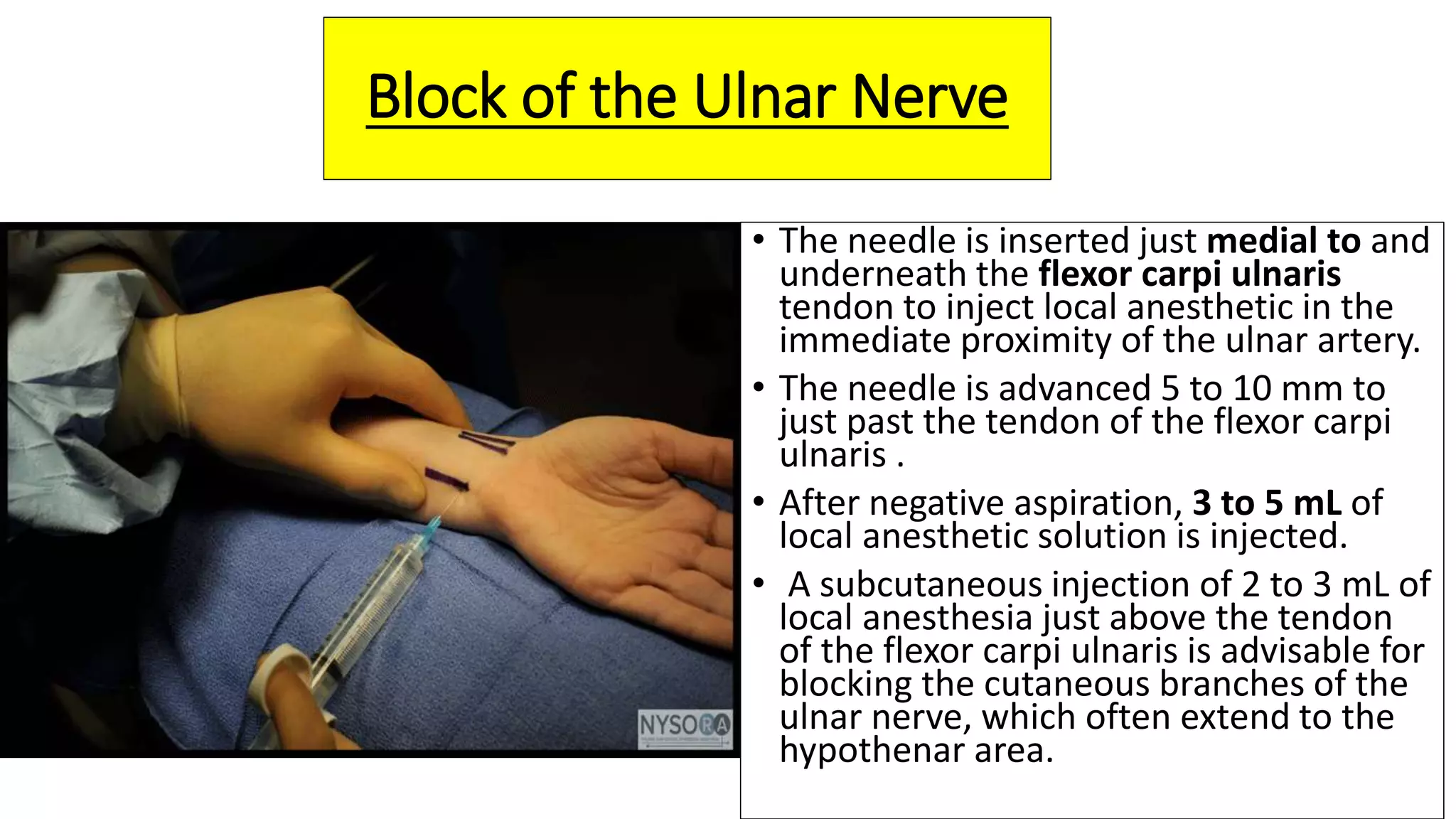 Peripheral Nerve block(ankle block,wrist block, digital block) | PPTX