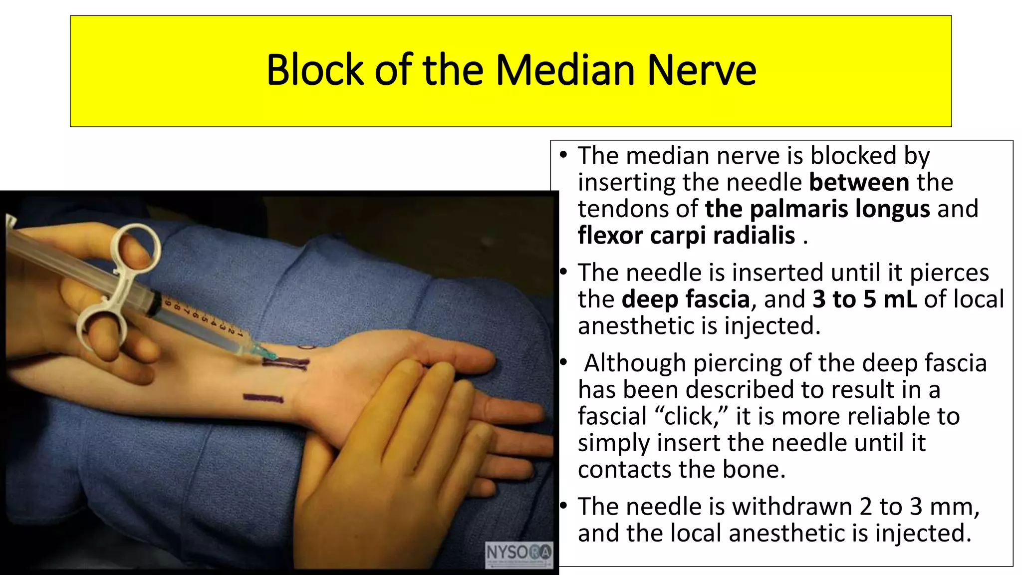 Peripheral Nerve block(ankle block,wrist block, digital block) | PPTX
