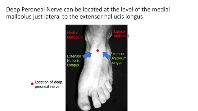 Peripheral Nerve block(ankle block,wrist block, digital block) | PPTX ...