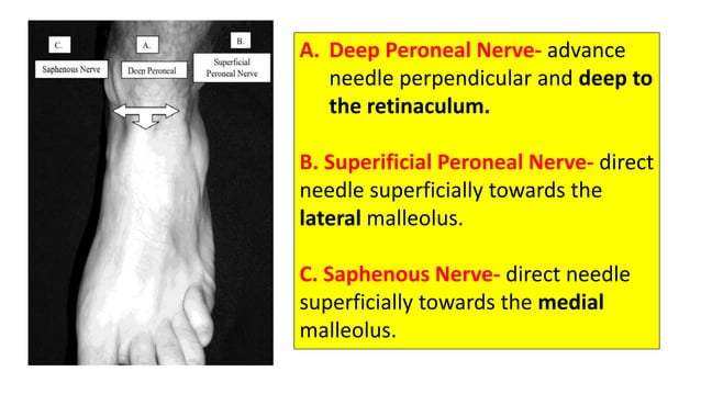 Peripheral Nerve block(ankle block,wrist block, digital block) | PPTX ...