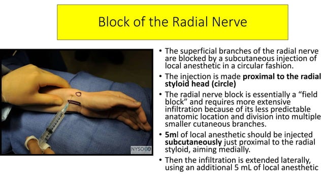 Peripheral Nerve block(ankle block,wrist block, digital block) | PPTX ...