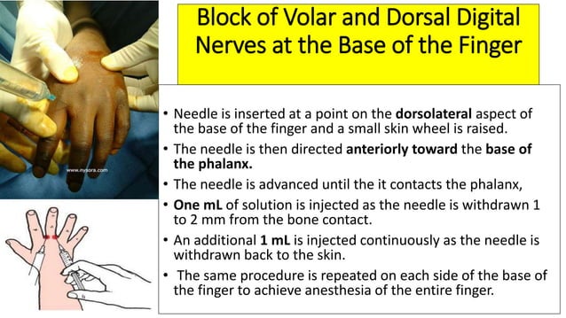 Peripheral Nerve block(ankle block,wrist block, digital block) | PPT