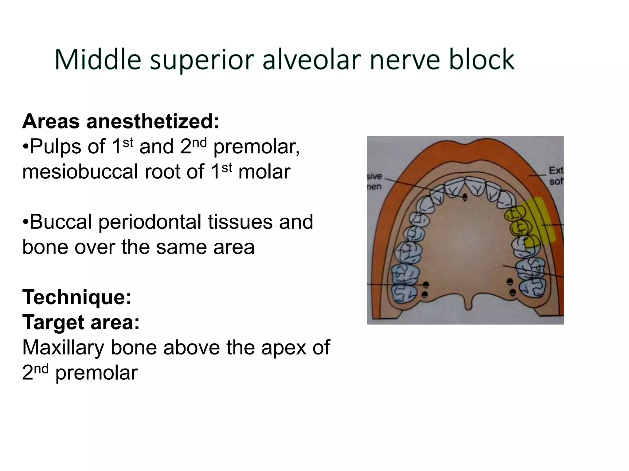 Nerve blocks | PPT