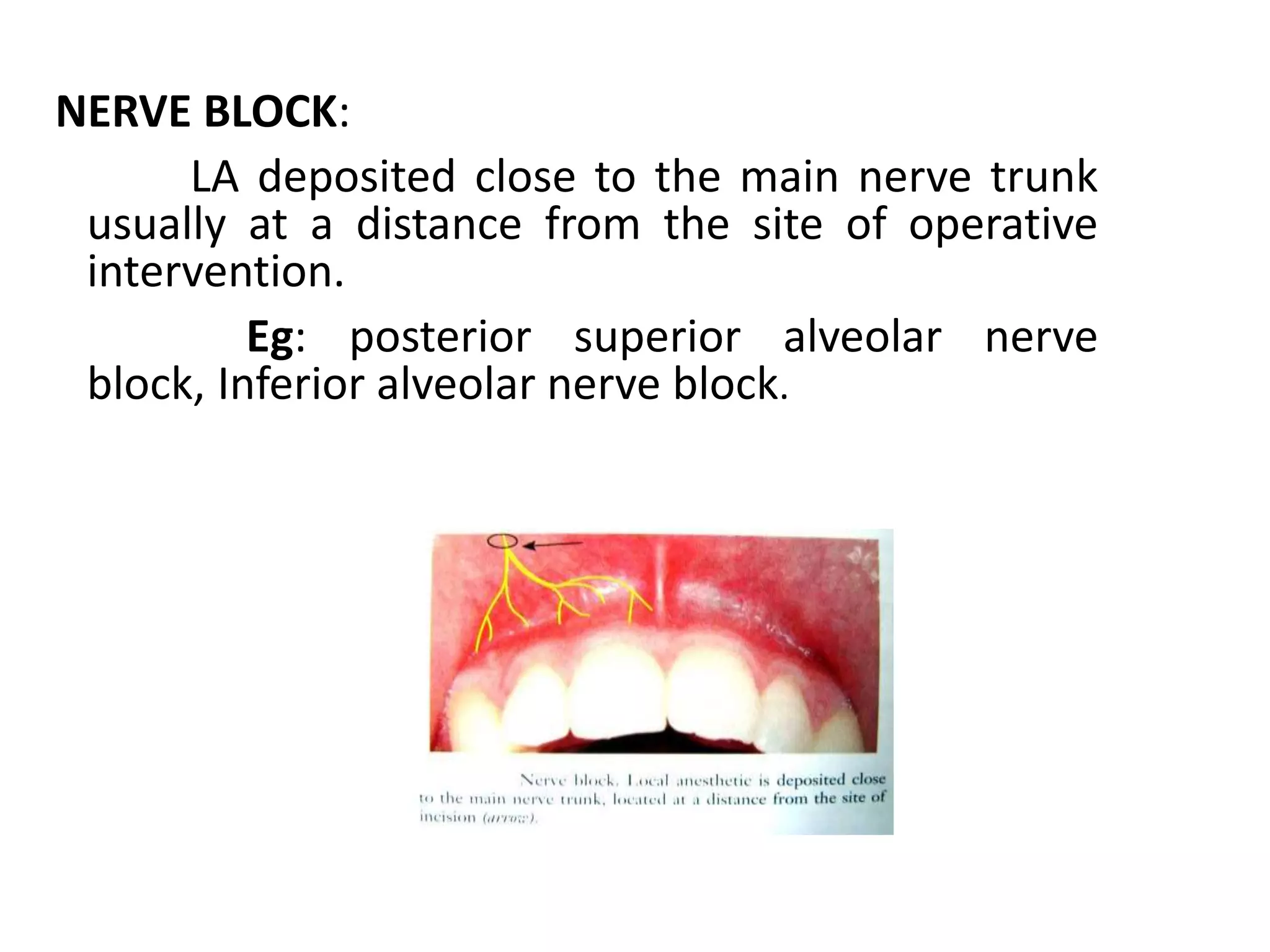 Nerve blocks | PPT