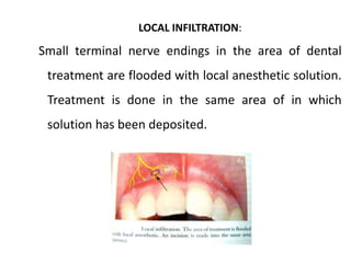 Nerve blocks | PPT