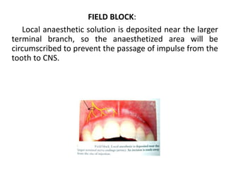 Ear Nerve Field Block