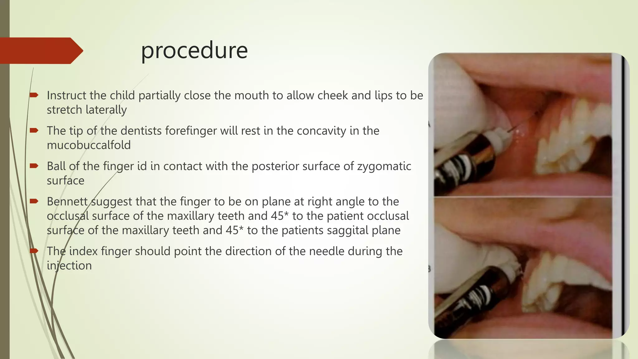 NERVE BLOCKS AND ANATOMICAL LANDMARKS IN PEDIATRIC DENTISTRY.pptx