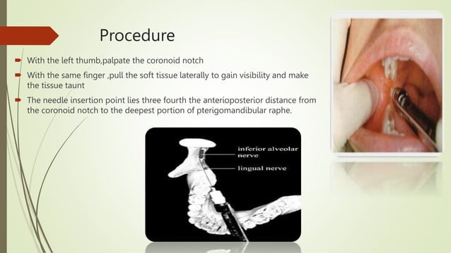 NERVE BLOCKS AND ANATOMICAL LANDMARKS IN PEDIATRIC DENTISTRY.pptx