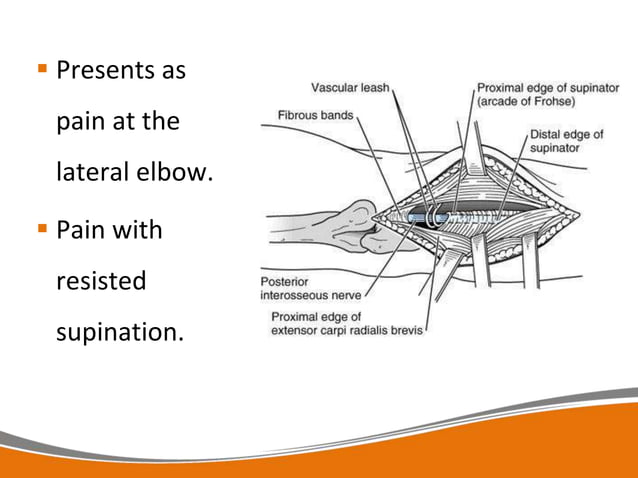 Nerve Compression for neuropaths 12.pptx