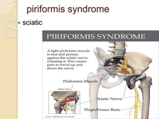 Peripheral Nerve compression syndrome | PPTX