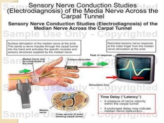 Peripheral Nerve compression syndrome | PPTX