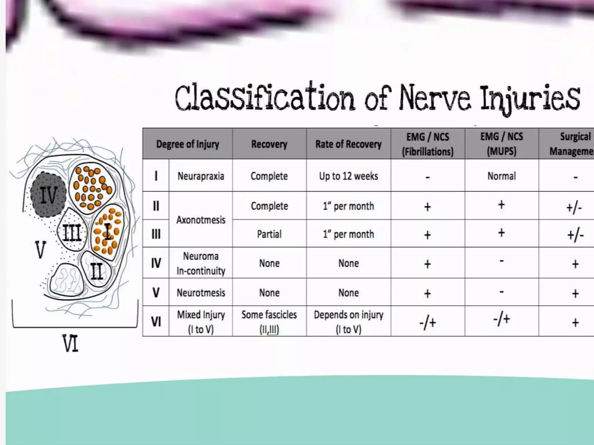 Nerve compression syndrome | PPTX