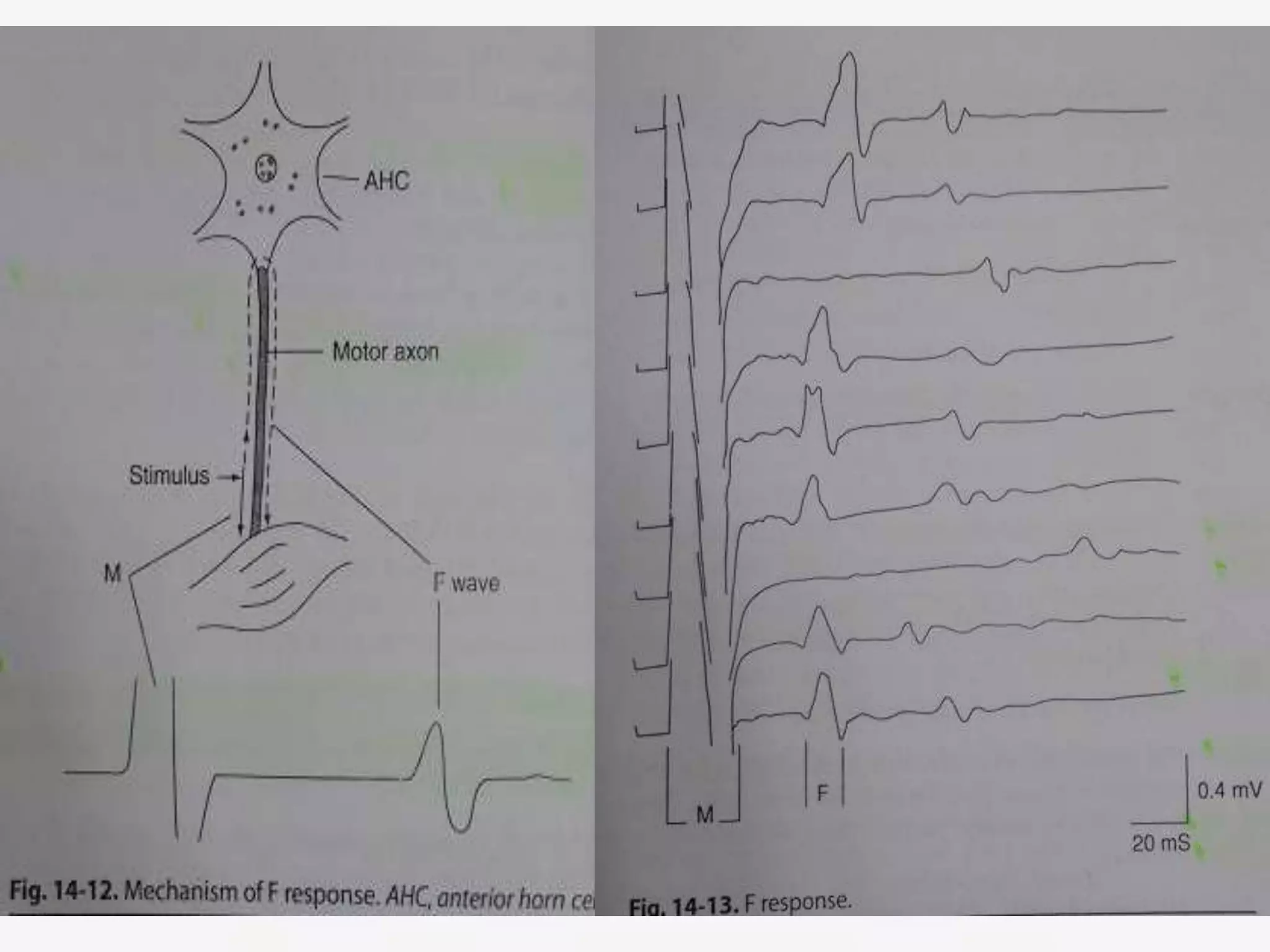 Nerve compression syndrome | PPTX