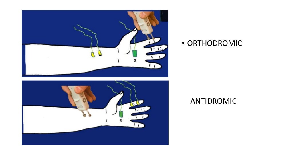 Nerve conduction studies