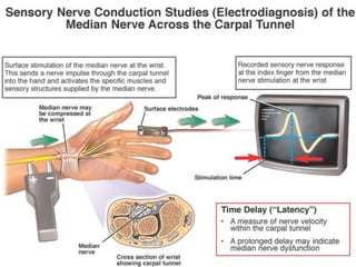 Nerve conduction study | PPTX