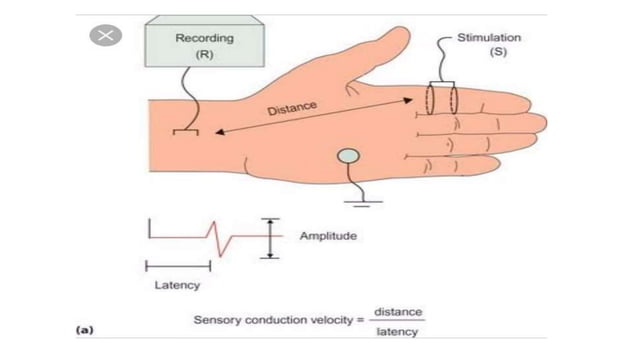 Nerve conduction study | PPTX